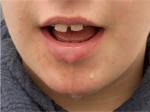 Excessive Drooling In Children: Drooling In Older Children